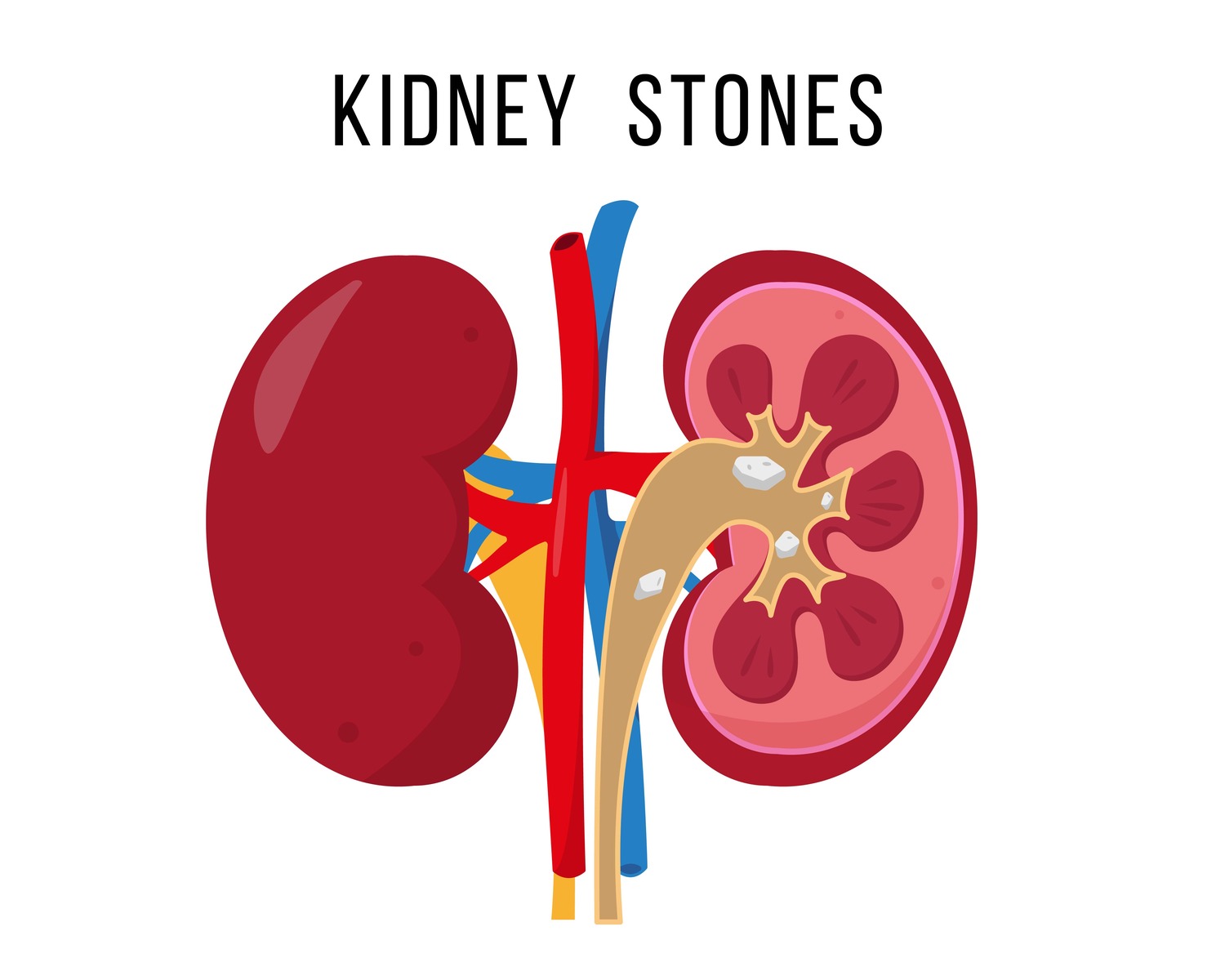 Getting to the Root: Understanding What Causes Kidney Stones - Urologist