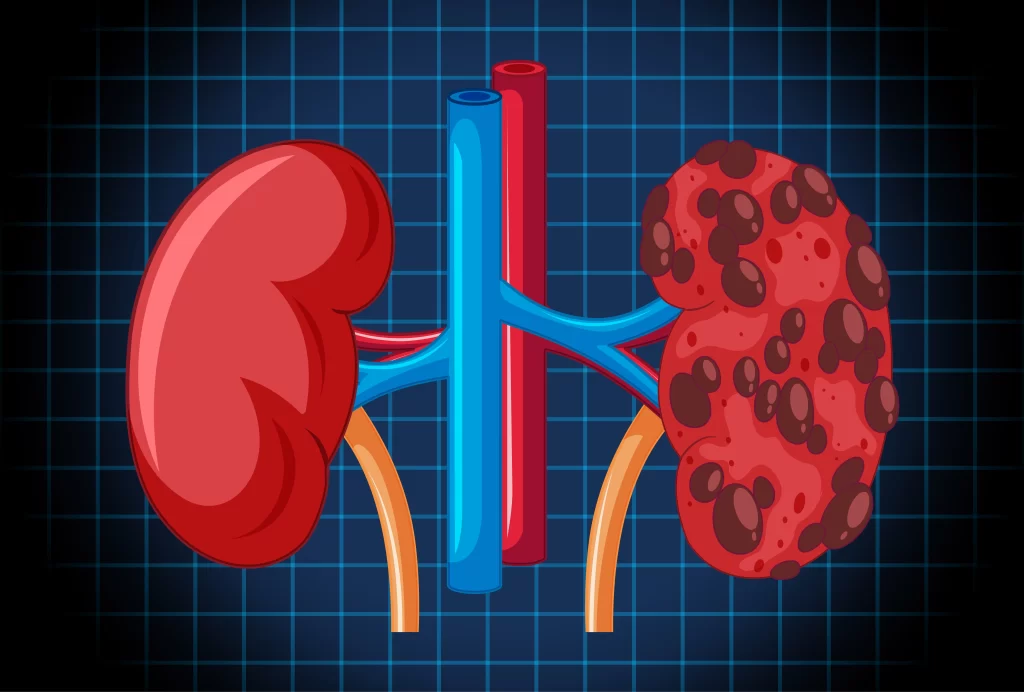 Understanding Kidney Infections: Causes, Symptoms, and Treatment ...